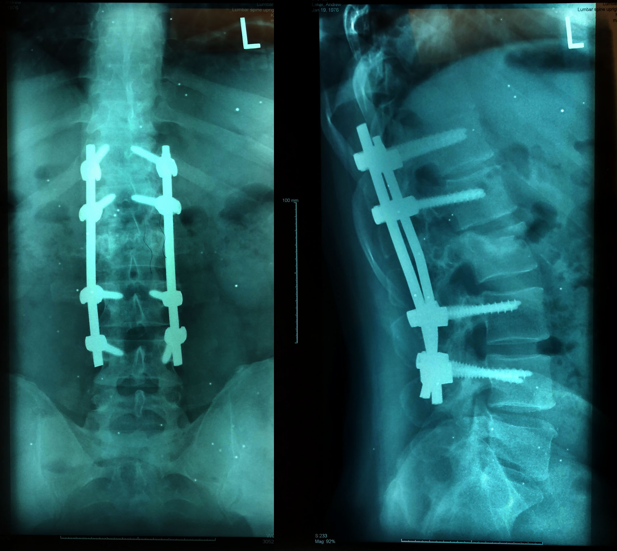 Recovering From a Broken Back: A Timeline - Hiking Illustrated